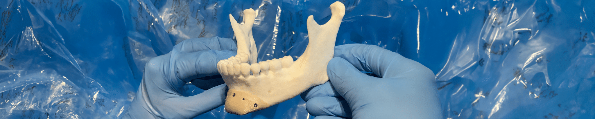 Onlay implantaten - 3D VSP